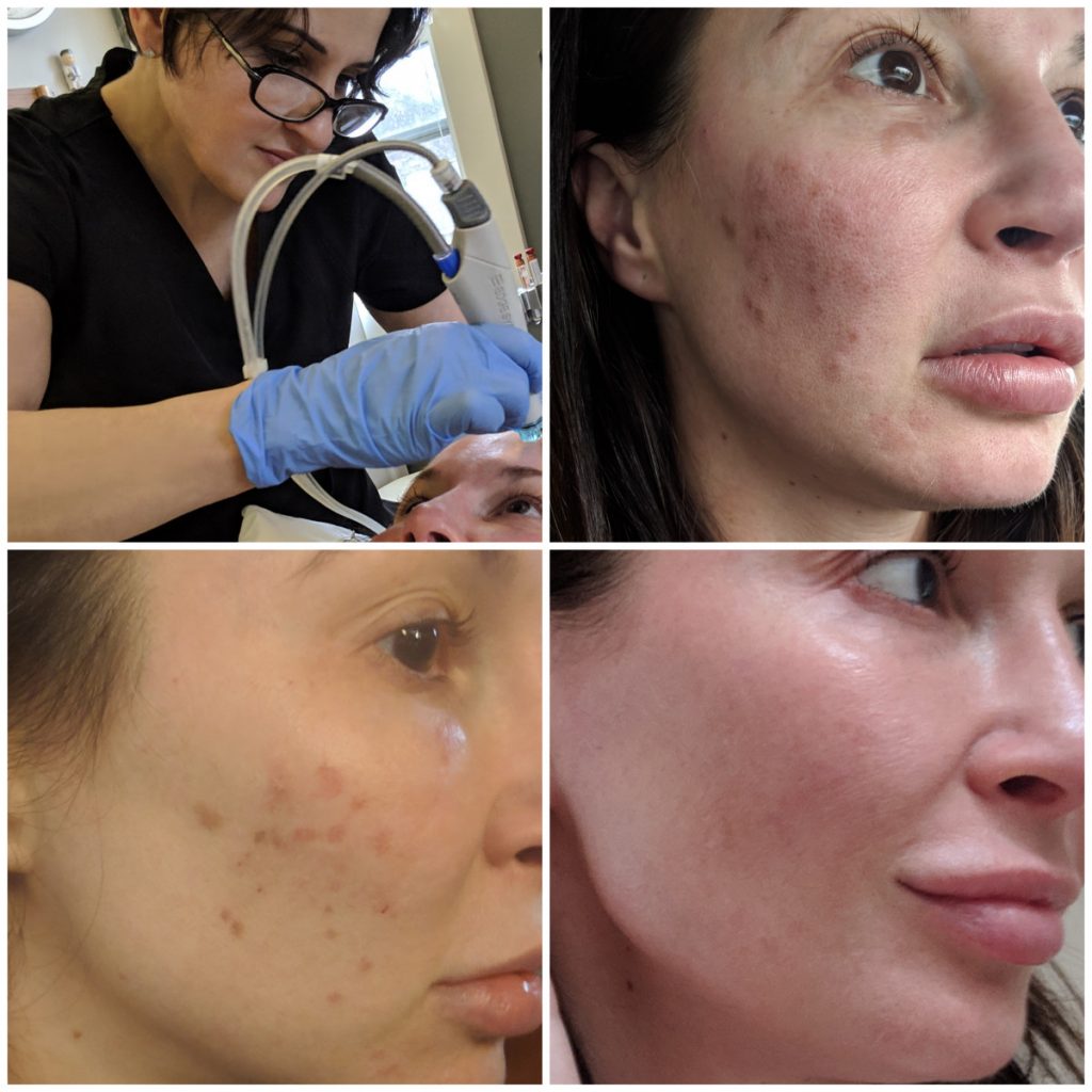 Freakin Laser Beams - Learning from the "Laser Queen" at Dr. Russo's ...